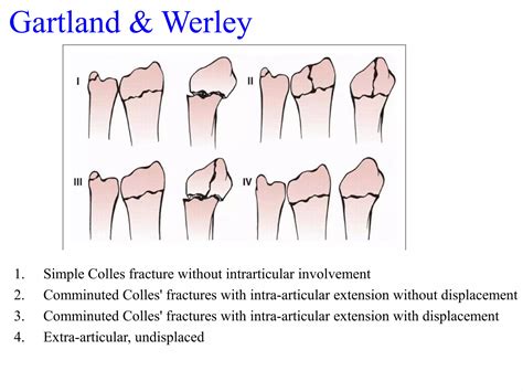 Distal Radius Fracture Ppt