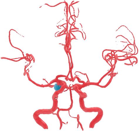Surface Based 3d Deep Learning Framework For Segmentation Of