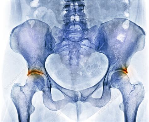 Femoroacetabular Impingement X Ray Stock Image C061 4736 Science Photo Library