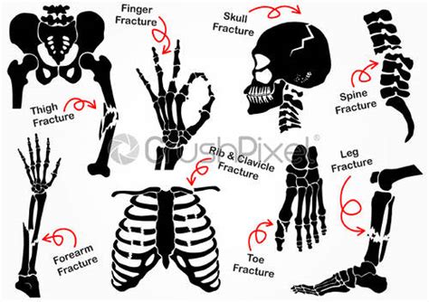 Bone Fractures Drop Shadow Black Glyph Icons Set X Ray Stock Vector Crushpixel
