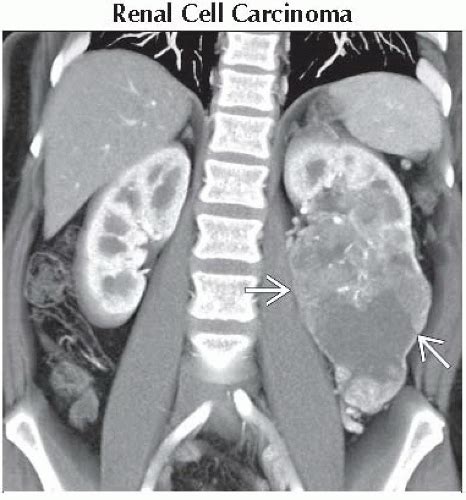 Da15 Db1 Solid Renal Mass Ffu1  Abdominal Key