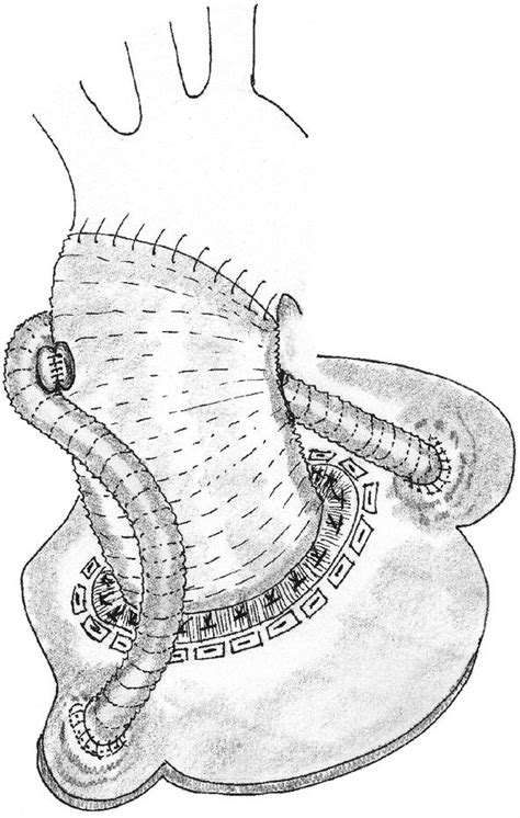 Isolated Aortic Root Aneurysms Intechopen