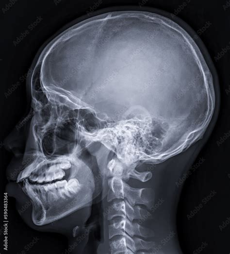 X Ray Image Of Human Skull Lateral View For Diagnosis Skull Fracture
