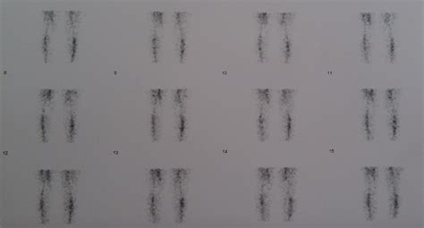 Diagnosis Of Shin Splint A Case Report Published In Surgicoll