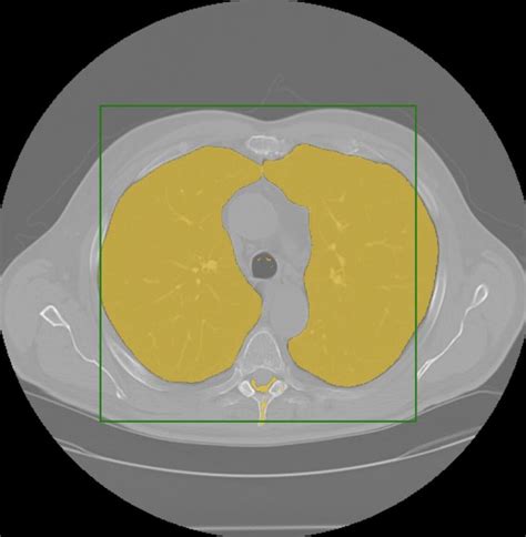 Nihal Shetty On Linkedin Sam Segmentanything Medicalimaging Deeplearning Computervision