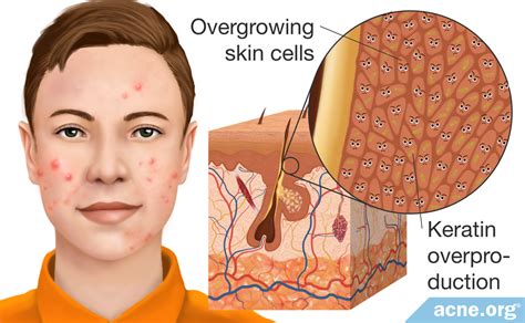 The Role Of Skin Cell Overgrowth Hyperkeratinization In Acne