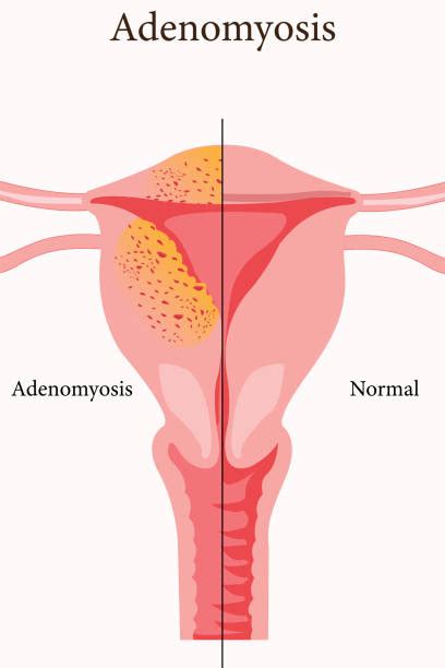 110 Adenomyosis Stock Illustrations Royalty Free Vector Graphics