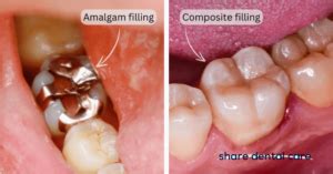 Amalgam Vs Composite Fillings Which Is Right For You Share Dental Care