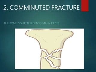 Fracture Pptx