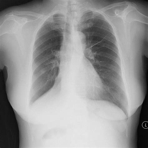 Chest Radiograph Atelectasis Is Indicated By The Covered Right Heart