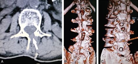 Ct Scan A And Reconstructed 3 Dimensional Ct Scan B And C Of This Download Scientific
