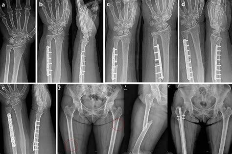 A A Year Old Woman Presented With Mm Positive Ulnar Variance And Download Scientific