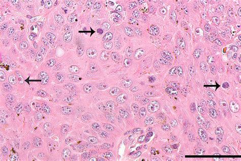 Cellular And Nuclear Pleomorphism And Atypia Vesicular Nuclei
