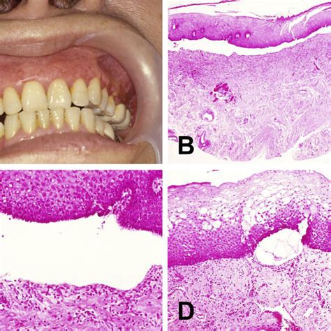 Subepithelial Cleavage With Basal Layer Preservation A Hande ×40