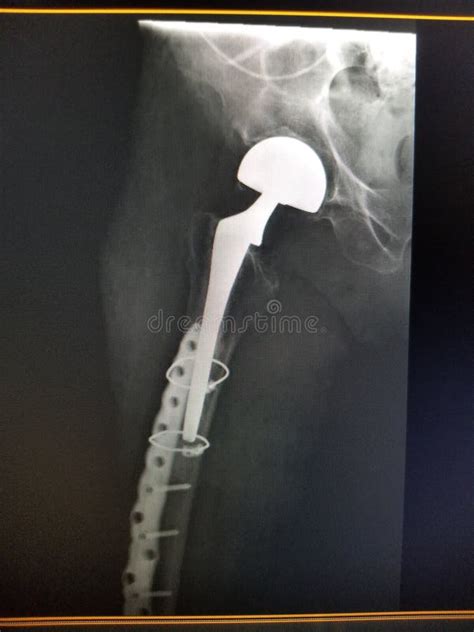 Right Prosthetic Hip Orif Hardware In Place Stock Image Image Of Orif Science 246940373