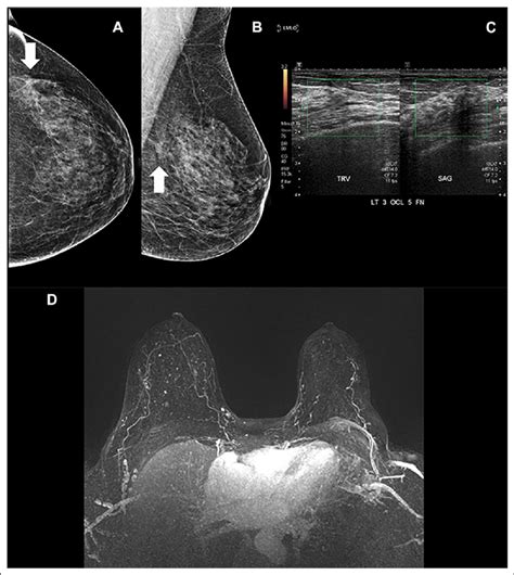 Screening Mammography Shows A Developing Focal Asymmetry With