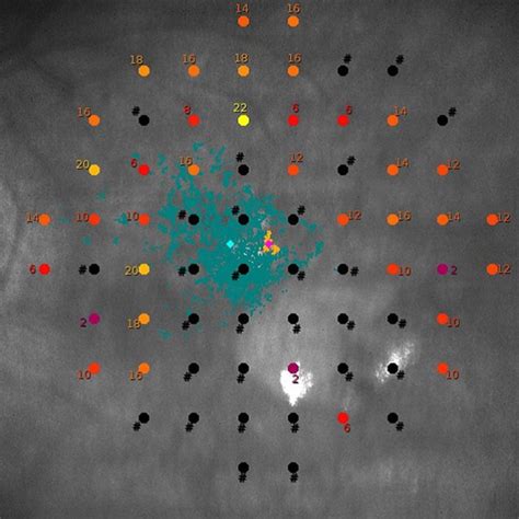 A Simulated Image Of A Logmar Visual Acuity Test Is Shown Without A Download Scientific