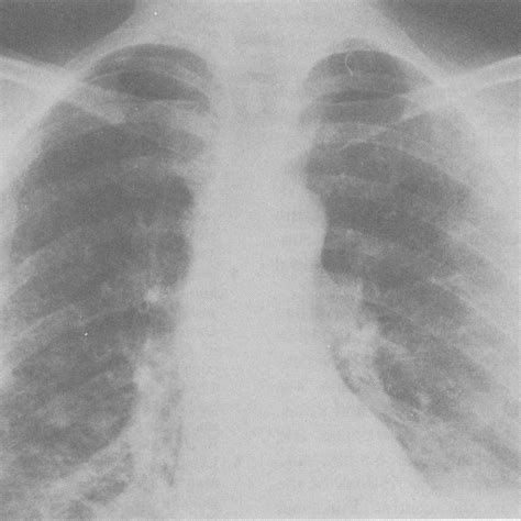 Bilateral Interstitial Edema 24 Hours After Admission Of Patient With