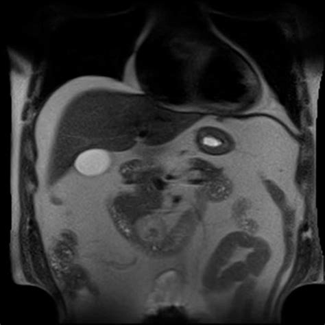 Duodenal Gist Body Mr Radiology Case Studies Ctisus Ct Scanning