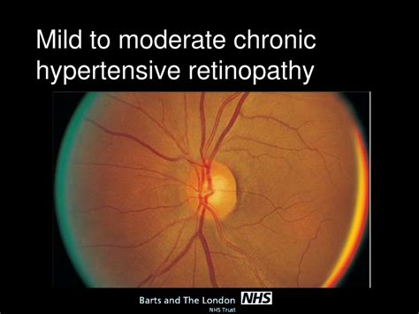 Ppt Systemic Disease And The Eye Powerpoint Presentation Free