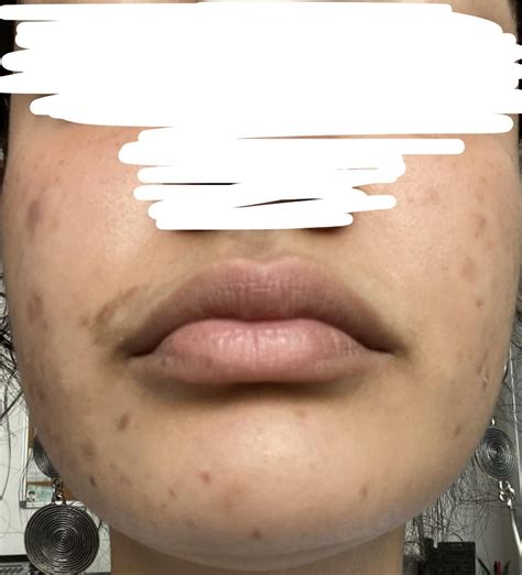 Hyperpigmentation Solution Reuroskincare