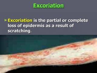Excoriated Definition Skin Excoriation Symptoms Causes Treatment