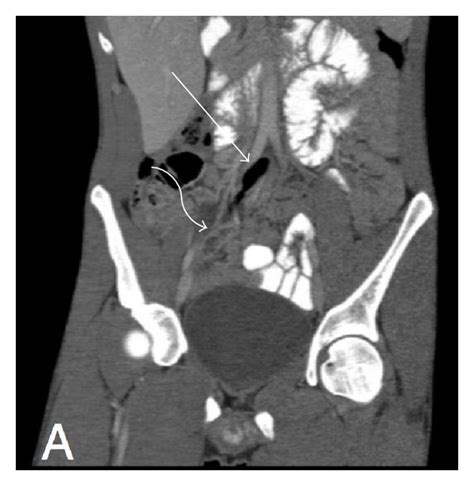 Retroperitoneal Air Straight Arrow Adjacent To Inflamed Retrocecal