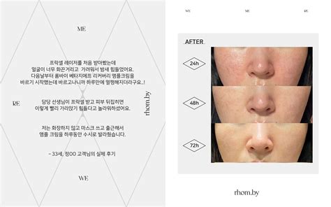 피코 프락셀 프락셀과 다른건가요 롬바이