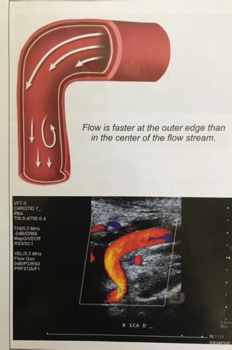 Vascular Waveforms Study Set Medicine Terms And Definitions Flashcards