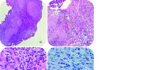 Biopsy Of The Posterior Wall Of The Urinary Bladder Compatible With Download Scientific