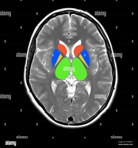 Magnetic Resonance Imaging Mri Scan Showing Normal Brain Anatomy With