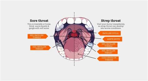 Strep Throat White Spots On Tonsils