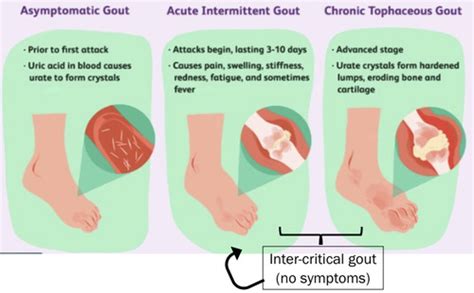 Gout And Hyperuricemia Flashcards Quizlet