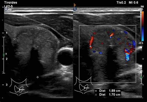Thyroid Usg Ti Rads 5 Thyroid Nodule With Dimensions Of 1 89 X 1 70 Cm Download Scientific