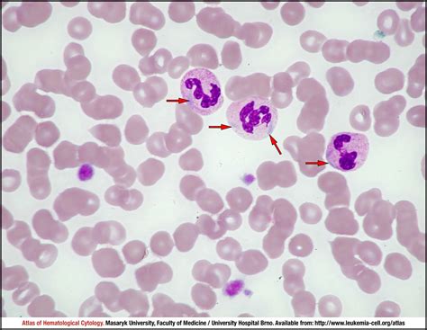 May Hegglin Syndrome