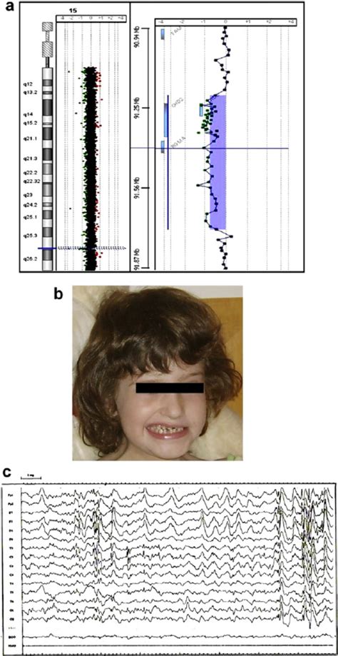 A Copy Number Determination Of Chromosome 15 Of Our Patient Obtained