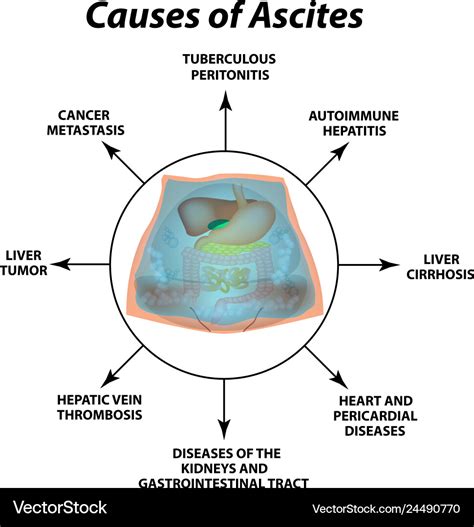 Peritoneal Cavity Ascites Ascites Free Fluid In The Abdominal Cavity