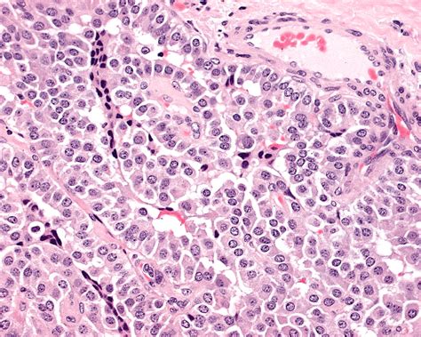 Pathology Outlines Medullary Thyroid Carcinoma