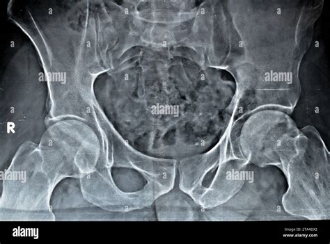 Plain X Ray Of Both Hip Joints Revealed Slight Narrowing Of Superolateral Aspect Of Both Hip