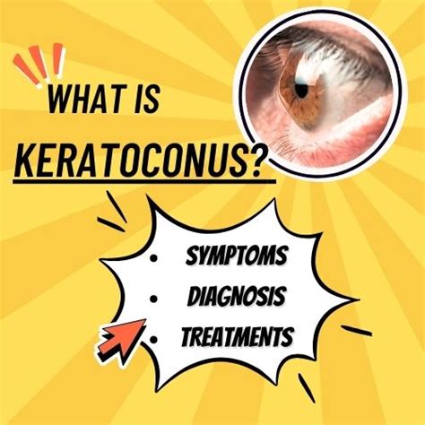 What Is Keratoconus Symptoms Diagnosis And Treatments