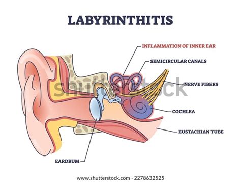 Labyrinthitis Inner Ear Infection Medical Inflammation Stock Vector