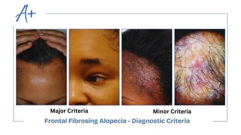 Frontal Fibrosing Alopecia Treatment Symptoms And Causes