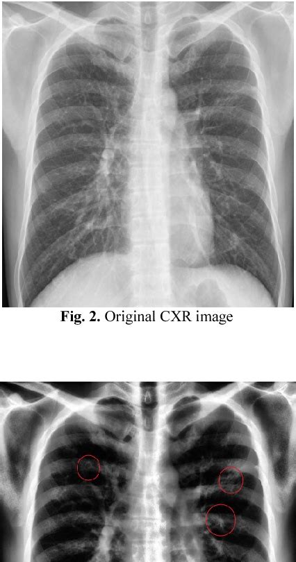 Figure 2 From Early Detection Of Tuberculosis Using Chest X Ray Cxr With Computer Aided