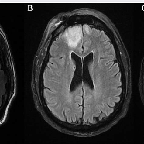 Mri Images Showing Progression Of The Frontal Lobe Lesion A Right Download Scientific Diagram