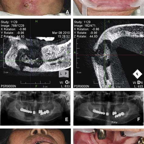 An Example Of Segmental Resection Of The Mandible In Case 18 A B