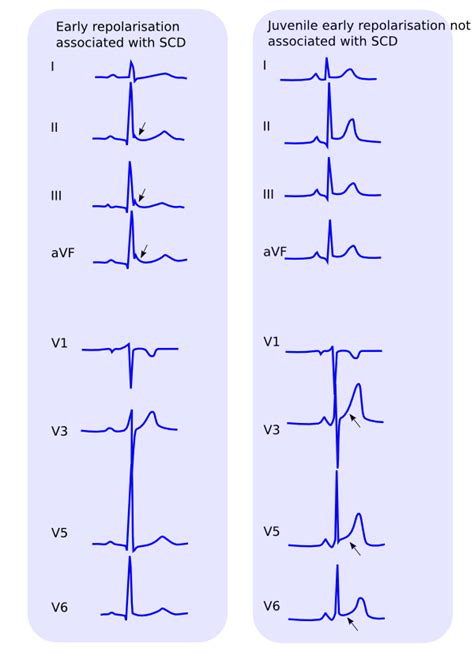 Repolarization St Tu Abnormalities Ecgpedia