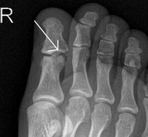 Interphalangeal Joint Sesamoid Of The Foot Wikism Sports Medicine Wiki