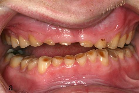 Extreme Case Of Teeth Grinding Faculty Of Medicine