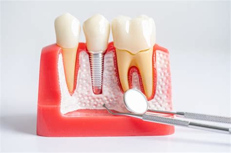 Dental Implant Artificial Tooth Roots Into Jaw Root Canal Of Dental