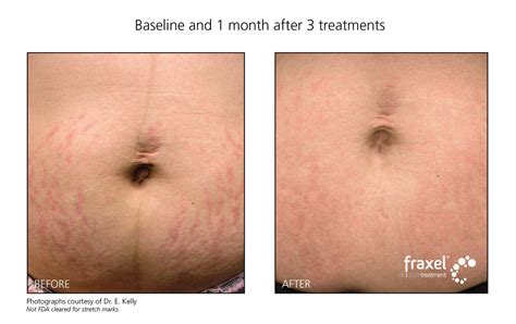 Fraxel Laser Clinic Laser Stretch Marks Treatment With Fraxel Sydney